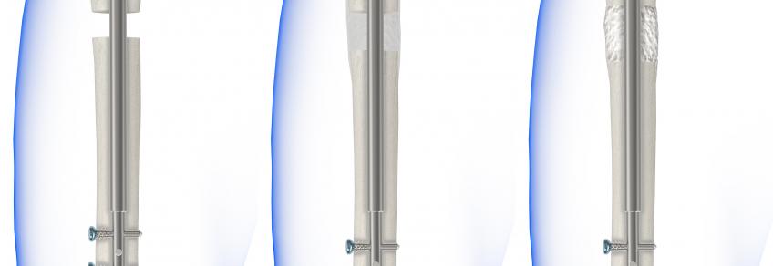 Precice | innosurge.com